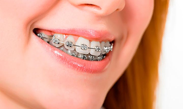 Convencional (brackets) - Clivadent