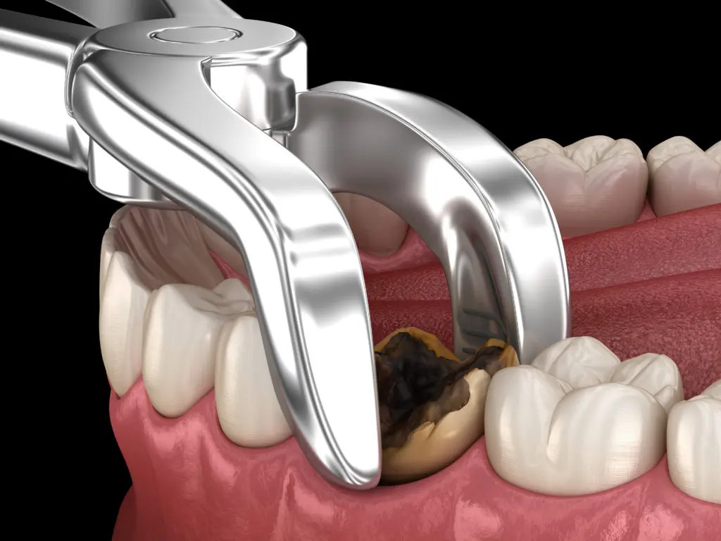 Extracción dental: procedimiento, costes y recuperación - Clivadent